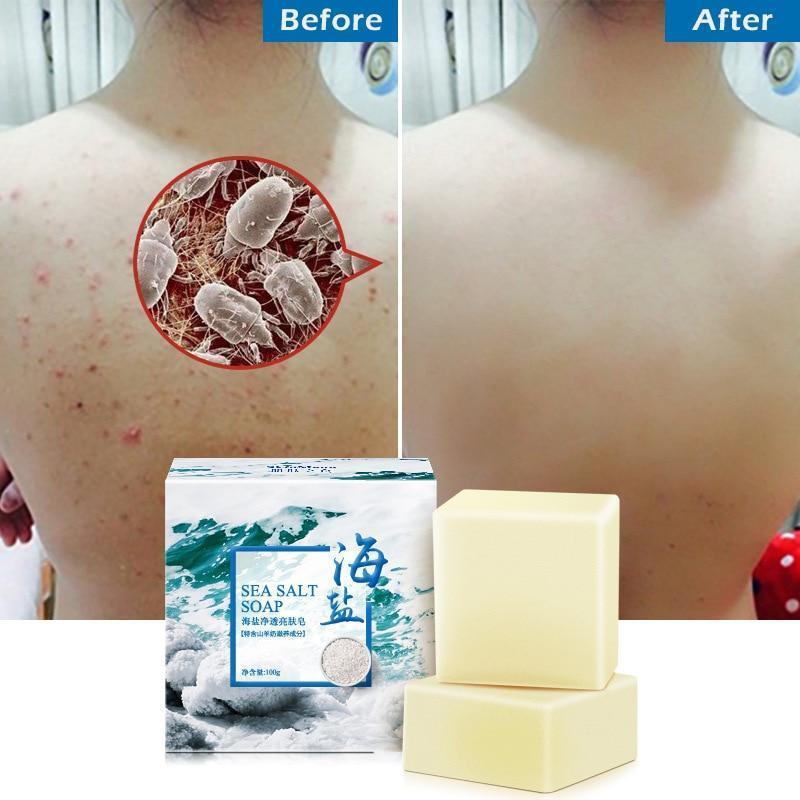 ACNE CLEANSING SOAP – Glow Tulip